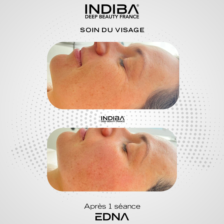 Nos traitements de rajeunissement du visage : INDIBA® Deep Beauty