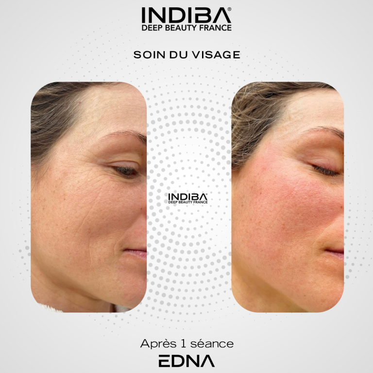 Nos traitements de rajeunissement du visage : INDIBA® Deep Beauty